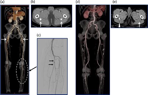 A Preoperative Ct Showing A Complete Psa With Aneurysm Formation And
