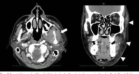 Figure 1 From Proliferative Fasciitis Myositis Involving The Facial Muscles Including The