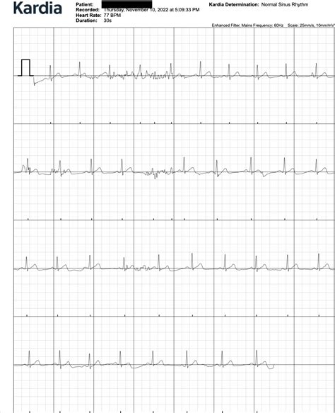 Hey Guys Cardio Said I Have Pvcs And I Took This At Home Any Thoughts
