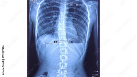 X Ray Showing Scoliosis Of The Lumbar Spine Scoliosis Is An Abnormal