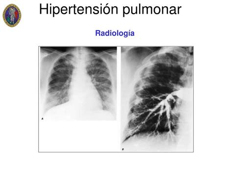 Ppt Hipertensión Pulmonar Cor Pulmonale Powerpoint Presentation Free