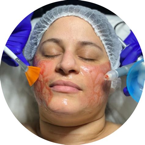 Stem Cells Micro Needling Ts Skin Clinic Spa