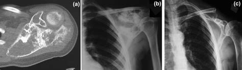 Scapular Osteosarcoma Treated By Scapulectomy With Or Without Scapular Allograft A
