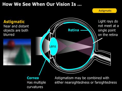 Astigmatism Treatments In Jacksonville Gulani Vision