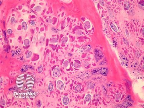 Verruca Plantaris Histology