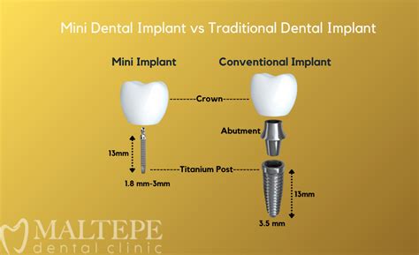 Mini Dental Implants Procedure Types Costs And Success Rates