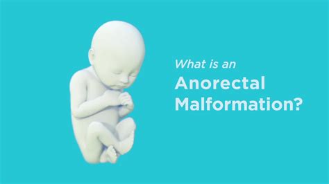 Anorectal Malformation Is The Generic Name That Includes Recto Perineal