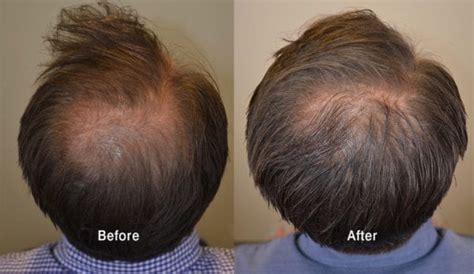 Topical Minoxidil Hair Growth Results Impressive Minoxidil Results