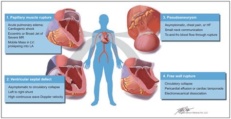 Complications Of Myocardial Infarction Cardio Guide