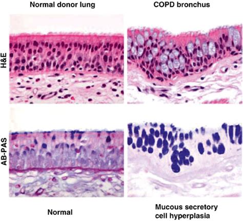 What Does Columnar Cell Hyperplasia Mean At Ruth Leet Blog