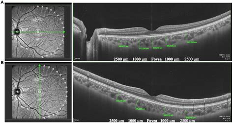 Frontiers Pattern Of Choroidal Thickness In Early Onset High Myopia
