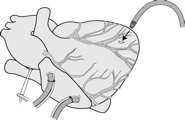 Transapical Aortic Cannulation For Cardiopulmonary Bypass In Type A
