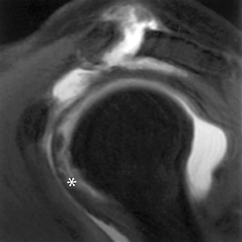Mr Arthrography Of Rotator Interval Long Head Of The Biceps Brachii