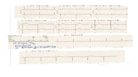 Ecg Presentation By Dr Nasir Uddin Ppt