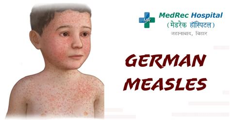 What Does The German Measles Rash Look Like