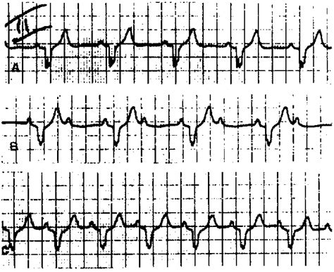 A Lead Ii Ecg In A Patient With Syncope Intraventricular Conduction Download Scientific