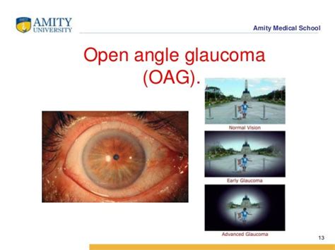 Open Angle Glaucoma