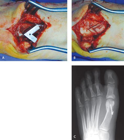 Chevron Osteotomy Musculoskeletal Key