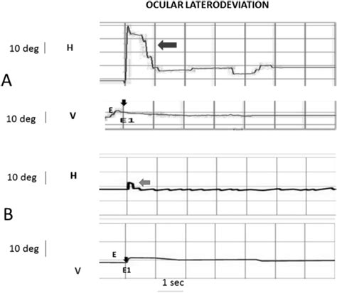 Graphical Recordings Of Ocular Lateral Deviation Old In A Patient