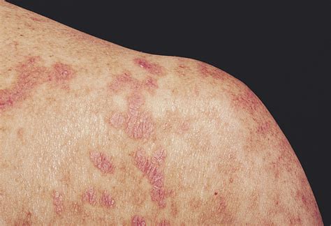 Lichenoid Dermatitis In Paraneoplastic Pemphigus Dermatology Jama Dermatology The Jama Network