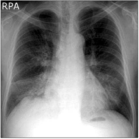 Pdf Bronchiolitis Obliterans Organizing Pneumonia In The Patient With