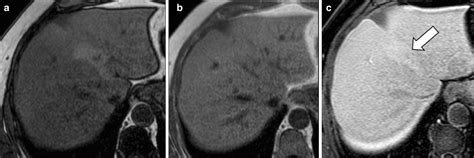 Liver Lesions Hyperintense On Hepatobiliary Phase Pacs