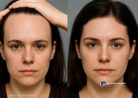 Forehead Reduction Surgery Hairline Lowering Surgery