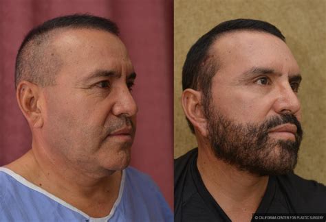 Patient 12166 Male Rhinoplasty Before And After Photos Encino