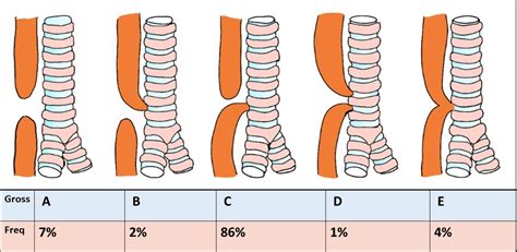 Tracheoesophageal Fistula Classification