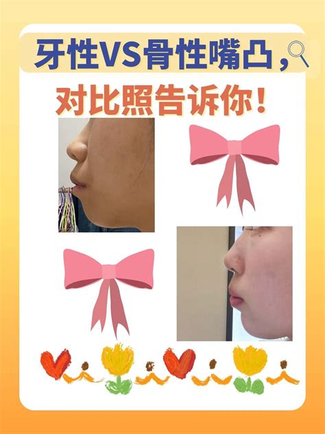 牙性vs骨性嘴凸，对比照告诉你！妙手医生