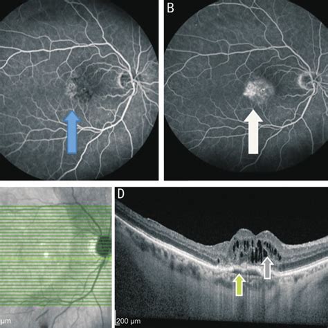 Final Oct After Anti Vegf Treatment Note The Presence Of Persistent