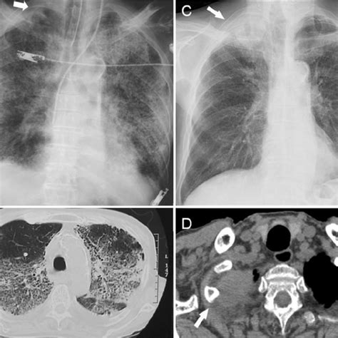 A X Ray Showing Bilateral Diffuse Reticular Shadows With A Nodular Download Scientific Diagram