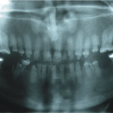 Orthopantomograph Showing Abnormal Crown Morphology And Hypercementosis