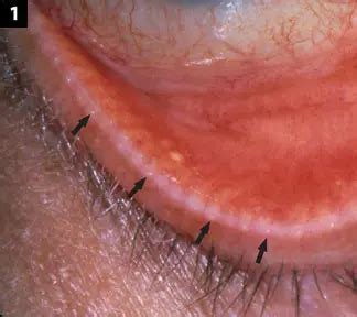 Posterior Blepharitis