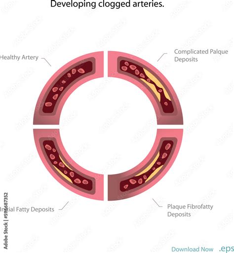 Cholesterol Deposits Plaques In The Heart Arteries And Inflammation