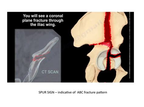 Imaging And Classification Of Acetabular Fracturespptx