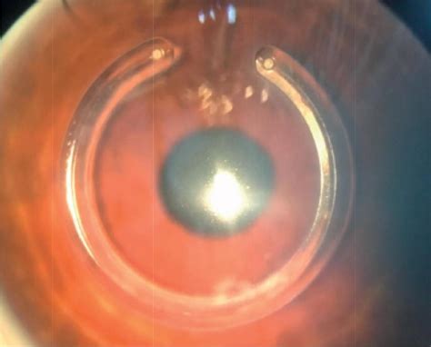 Advanced Keratoconus Case Study Ento Key