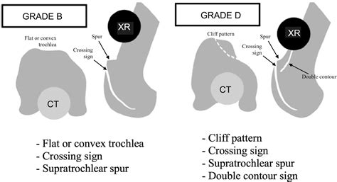 The Modified Trochleoplasty For Trochlear Dysplasia Types B And D