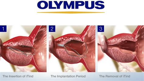 Itind Procedure Offers Long Lasting Treatment For Enlarged Prostate