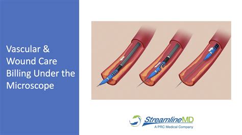 Coding And Billing For Diagnostic Angiography At The Time Of Intervention Streamlinemd
