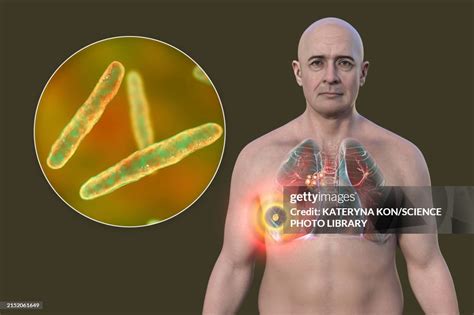 Primary Lung Tuberculosis With Ranke Complex Illustration High Res