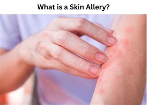Homeopathy Medicine For Skin Allergy Types Causes Symptoms