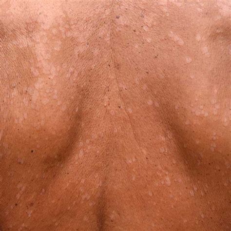 Pityriasis Versicolor