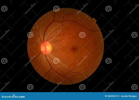 Medical Photo Tractional Eye Screen Diabetes Retinal Screening Stock