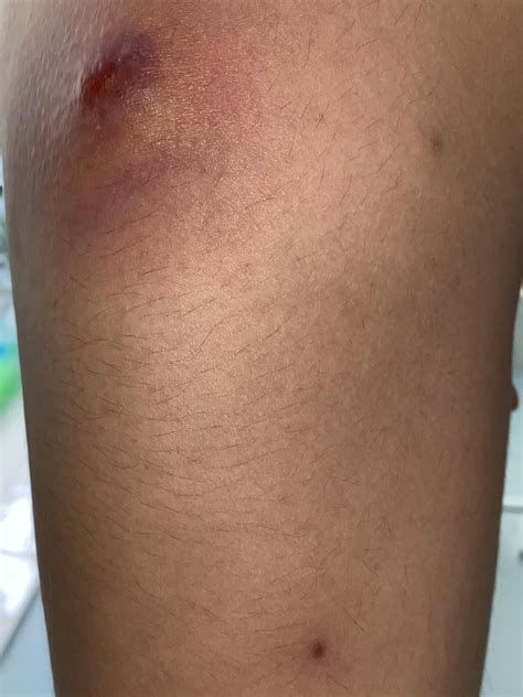 What Are These They Appeared On My Leg Yesterday And They Definitely