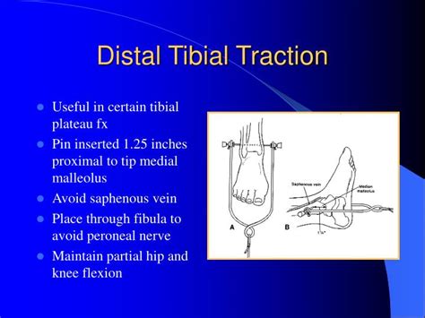 Ppt Orthopaedic Traction Powerpoint Presentation Id 210938
