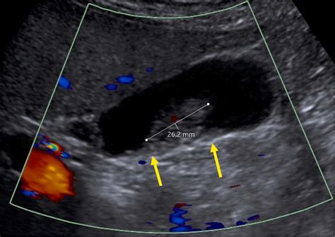 Follow Up Imaging And Surgical Costs Associated With Different Guidelines For Management Of