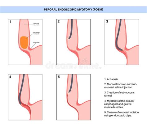 Myotomy Stock Illustrations 29 Myotomy Stock Illustrations Vectors