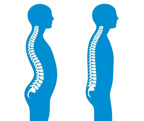 Lumbar Lordosis Person Hyperlordosis Causes Symptoms And Treatments