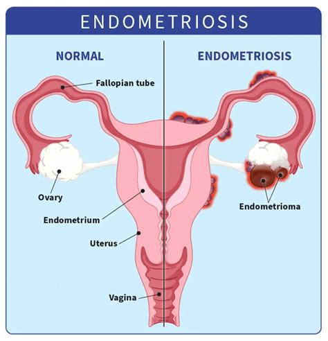 Endometriosis Guo Tai Tcm